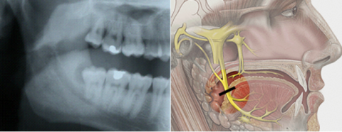 Trigeminal Nerve Injuries Neuralgia Dental Injections Implants Treatments